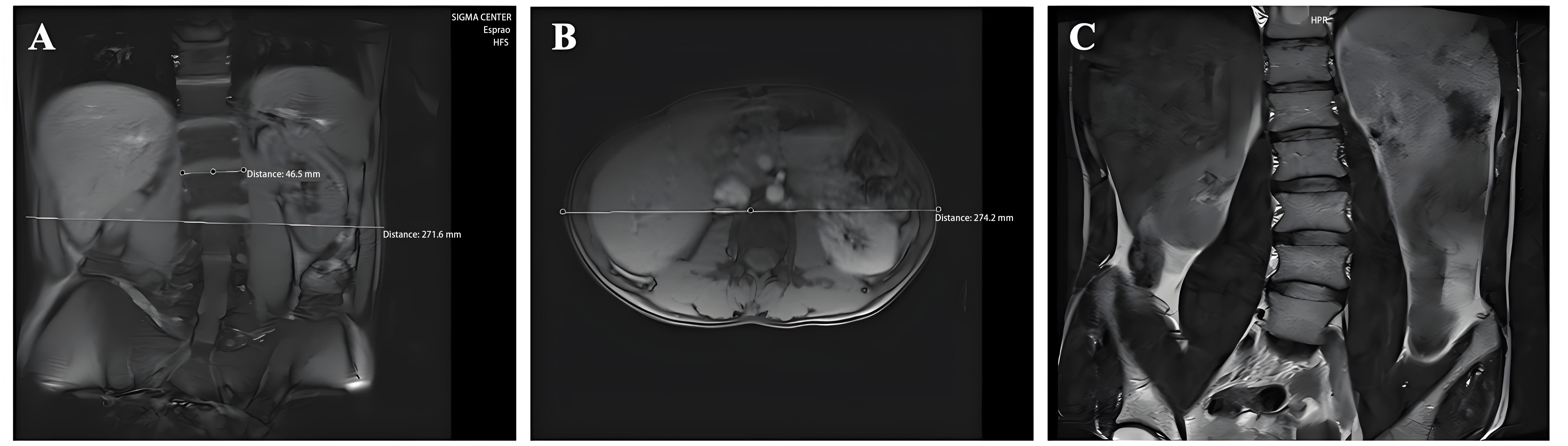 Revolutionizing spinal care: Three dimensional-printed customized ...