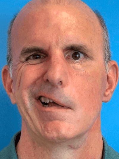 A 3-Dimensional printed embouchure-assistive device for musicians with ...